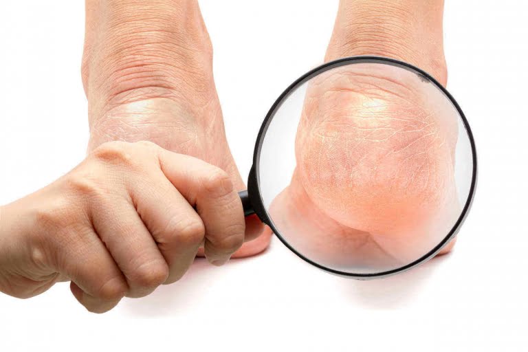 Pé rachado o que fazer ? | Dra. Larissa Montanheiro